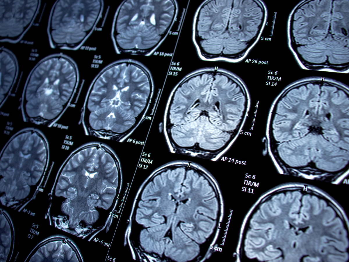 CT Scan vs. MRI Scan: Key Differences Explained | NextGen Diagnostic ...